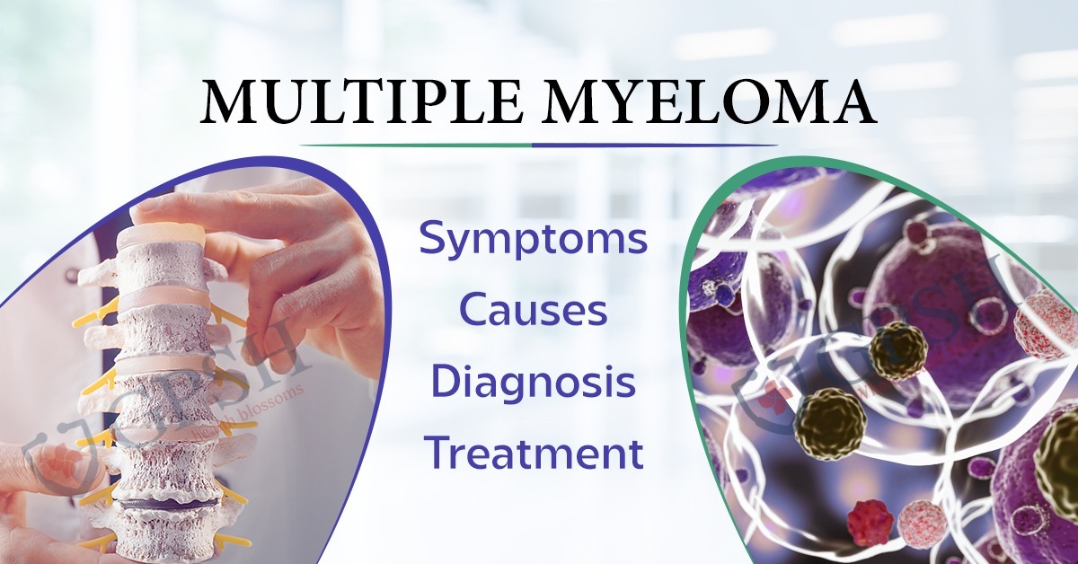Multiple Myeloma: Symptoms, Causes, Diagnosis and Treatment Multiple Myeloma: Symptoms, Causes, Diagnosis and Treatment